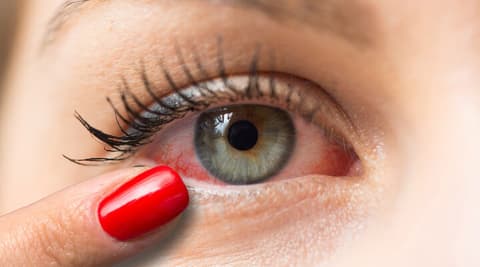 Swędzenie oczu w kącikach – przyczyny | Diag.pl